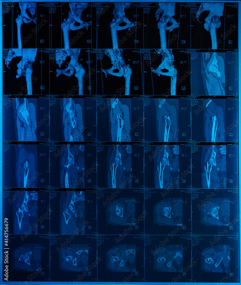 Magnetic resonance imaging (MRI) of the pelvis, femoral joint, titanium ...