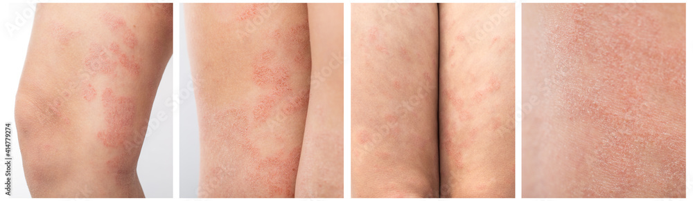 Panel Collage about acute atopic dermatitis on the legs of a child is a ...