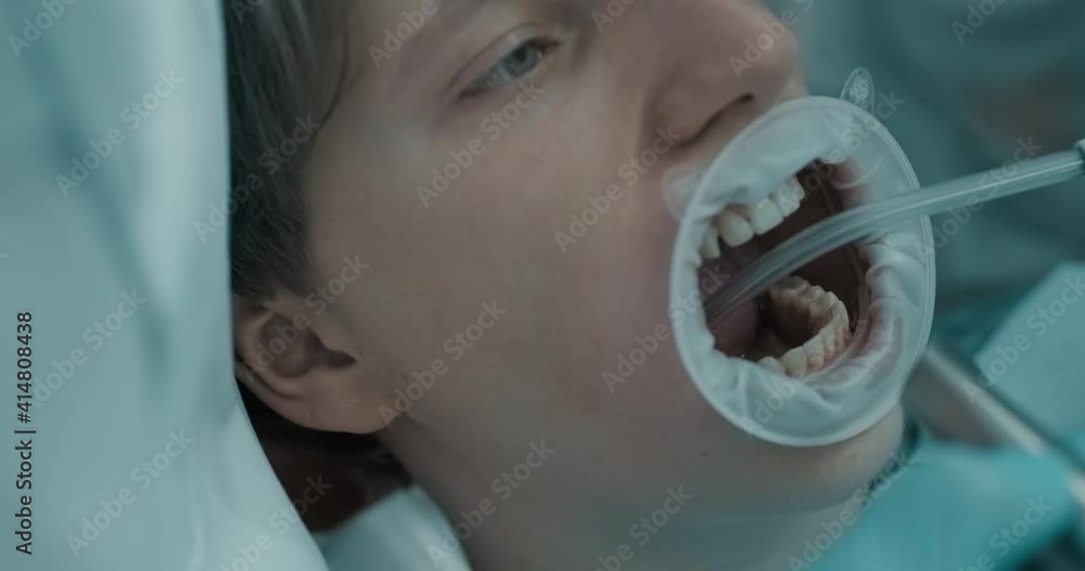 A male patient is wearing a mouth opener and having his mouth wide open ...