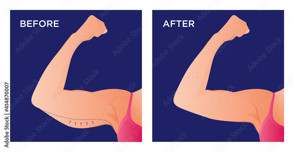 Arm with excess skin before and after surgical operation. Saggy skin ...