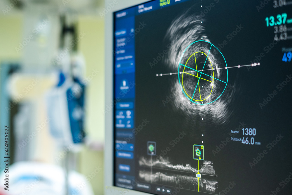 Intravascular ultrasound imaging (IVUS) at cardiac catheterization ...