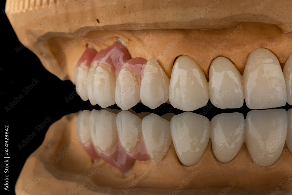 Close-up photo of a dental upper jaw prosthesis on black glass ...