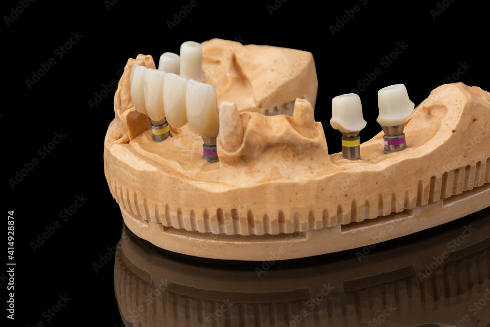 Close-up photo of a dental lower jaw prosthesis on black glass ...