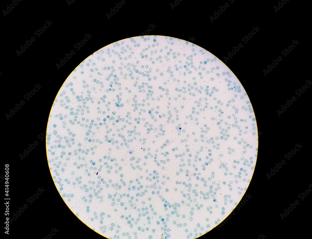 Reticulocyte count test is also useful for people with sickle cell ...