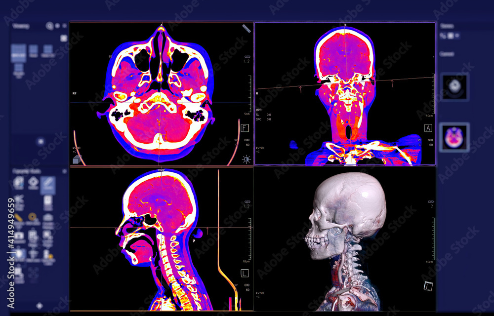 Colorful of CT angiography of the brain or CTA brain comparison Axial ...