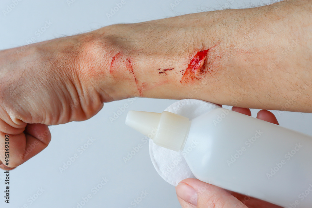 Treatment of the wound on the hand. Decontamination with a sterile ...