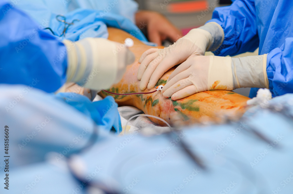 Preparing the patient for phlebectomy surgery. Surgical field marking ...