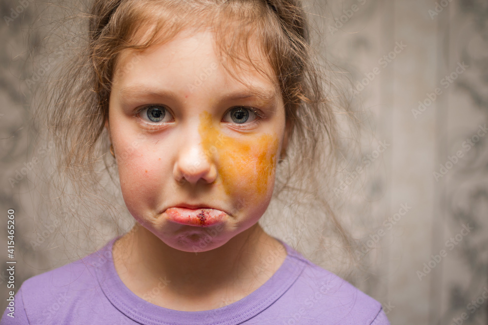 Portrait of a little girl with a split lip and abrasions on her face ...