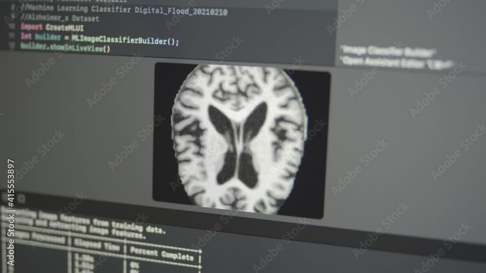 2.37 Real Neural Network Machine Learning Analyzes Alzheimer Disease on ...