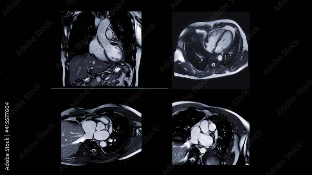 MRI heart or Cardiac MRI ( magnetic resonance imaging ) of heart in ...