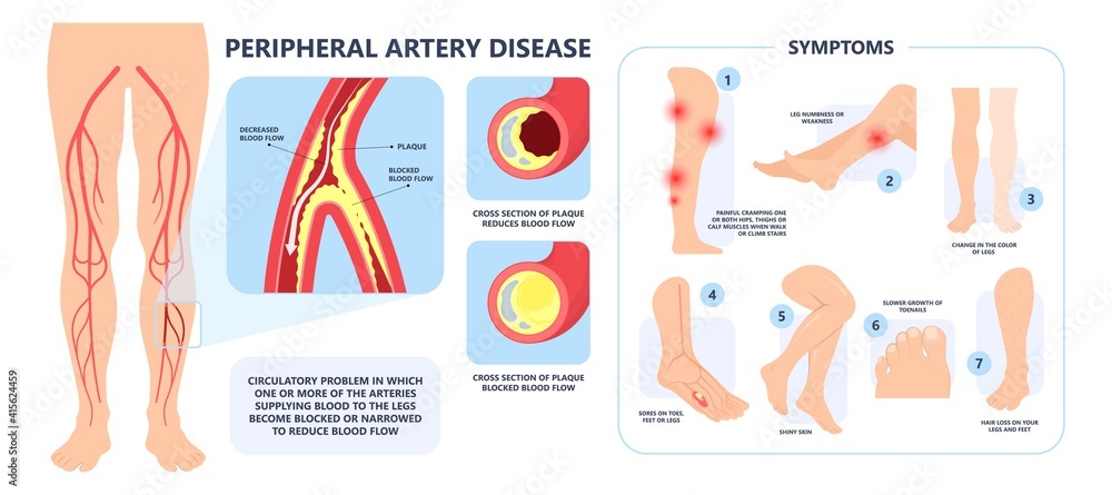 Graft artery PAD flow legs pain fatty treat hips Calf toes feet High ...