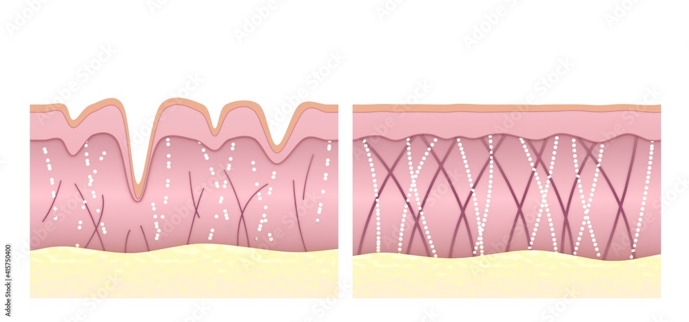 Comparison of old and young skin. CG illustration showing wrinkled ...