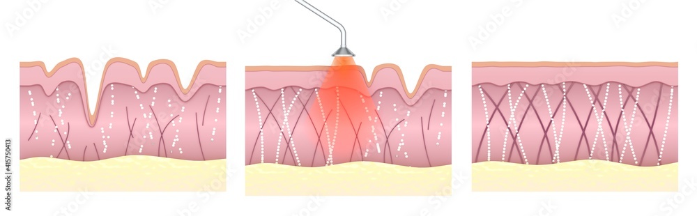 Laser skin resurfasing illustration. Skin before and after treatment ...
