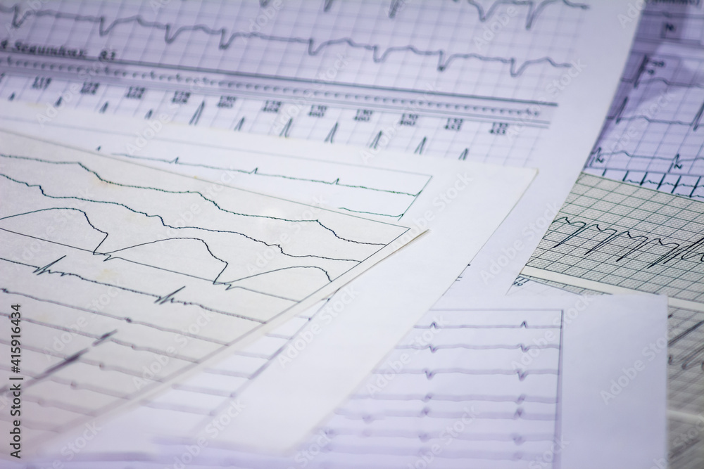 Tracing of electrocardiograms on graph paper. Records of heart activity ...