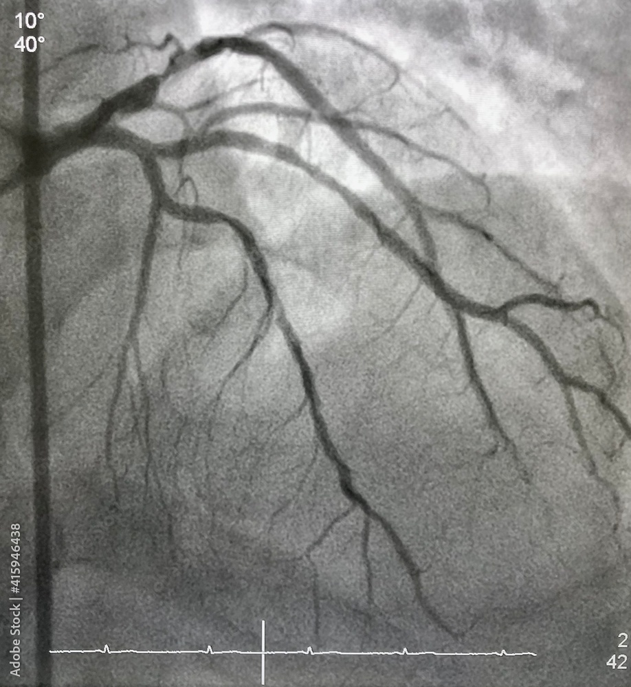 Poster Coronary angiogram shown dual left anterior descending artery ...