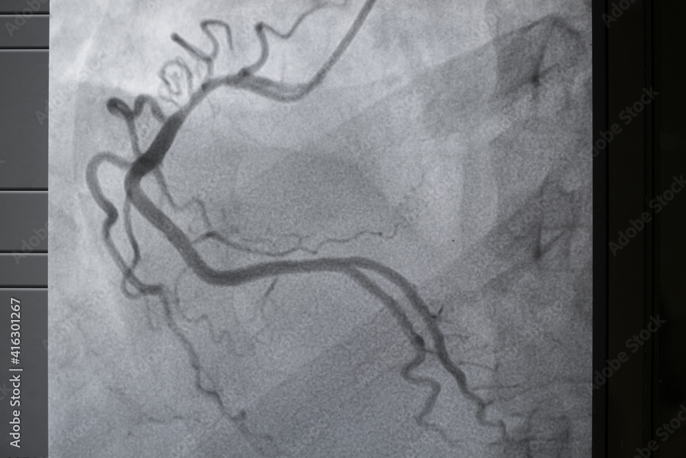 Coronary angiogram , medical x-ray for heart disease. Coronary artery ...