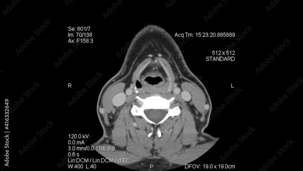 Axial Tomography: CT Scan layers from top of head to mid-thoracic Stock ...