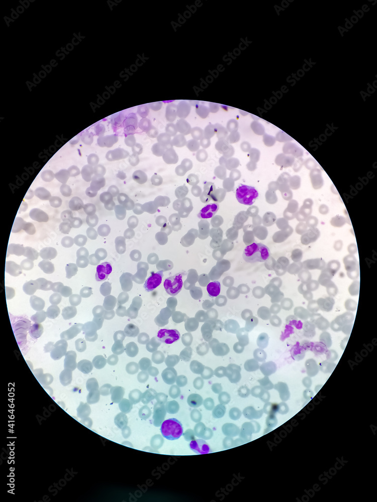 Microscopic view of hematology slide. RBC. WBC. closeup. Stained slide ...