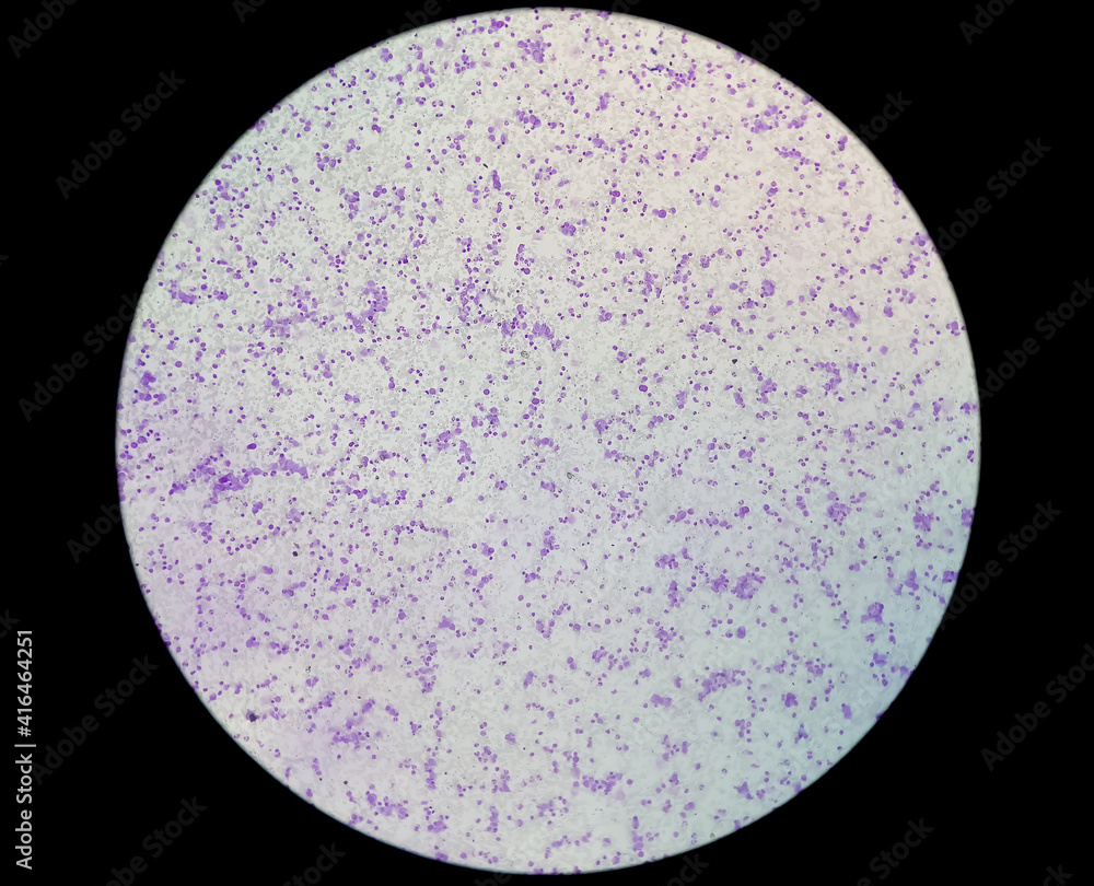 Eessential thrombocytosis blood smear showing abnormal high volume of ...