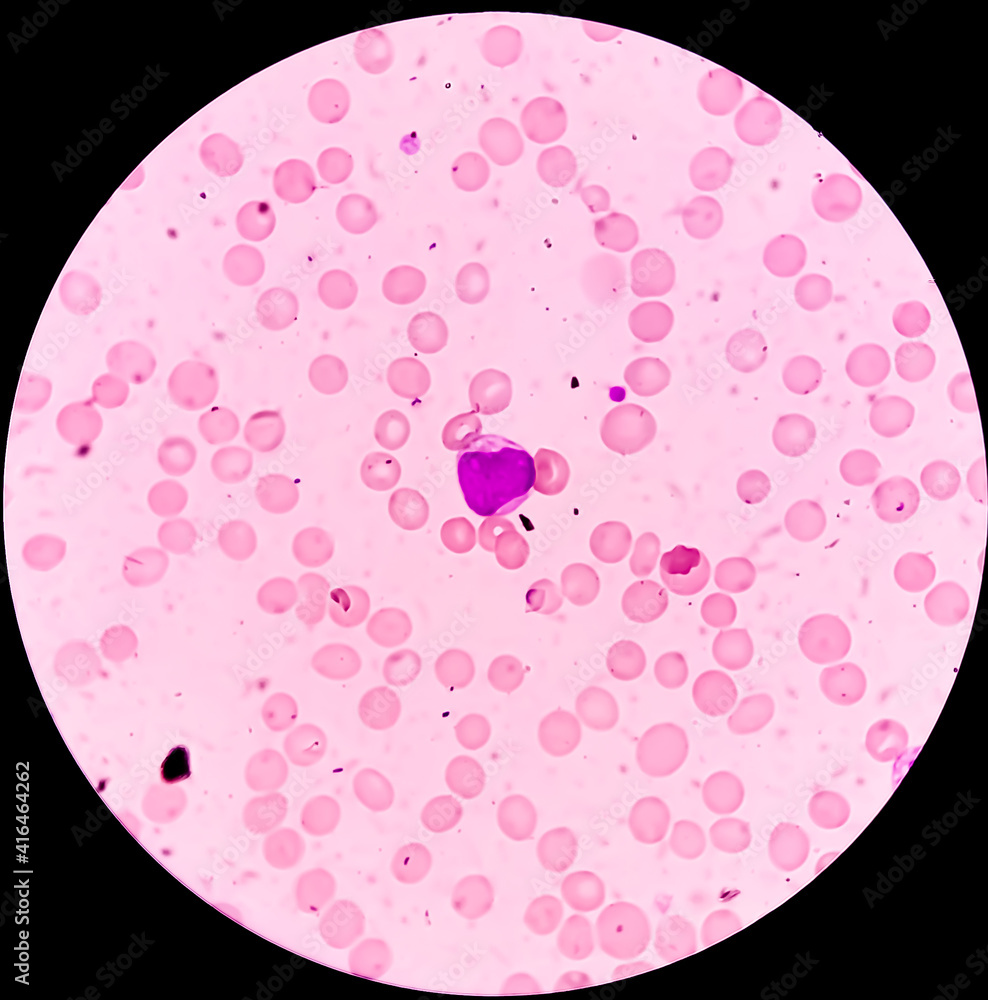 Microscopic view of Acute myeloid leukemia (AML), myeloblastic Leukemia ...