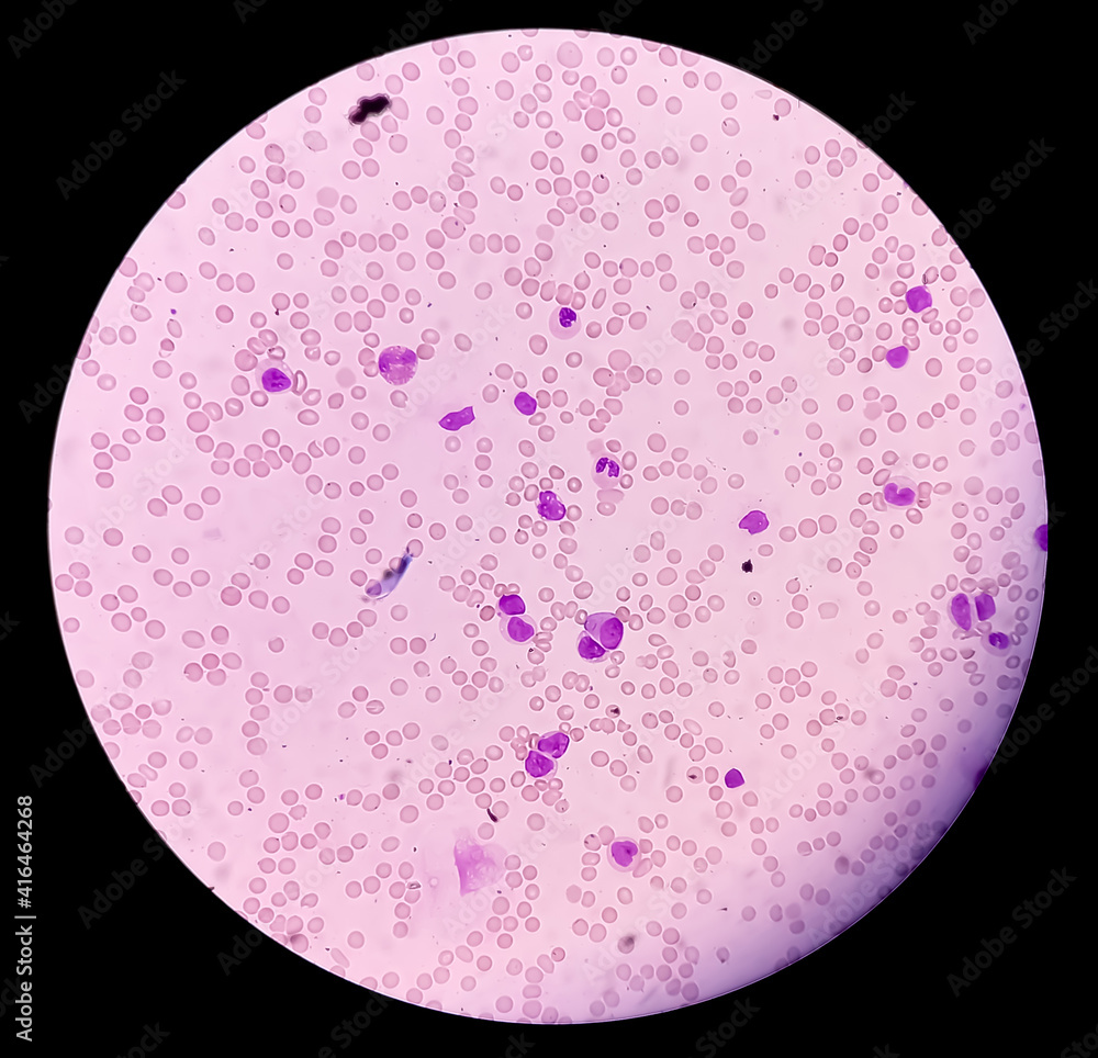 Microscopic view of Acute myeloid leukemia (AML), myeloblastic Leukemia ...