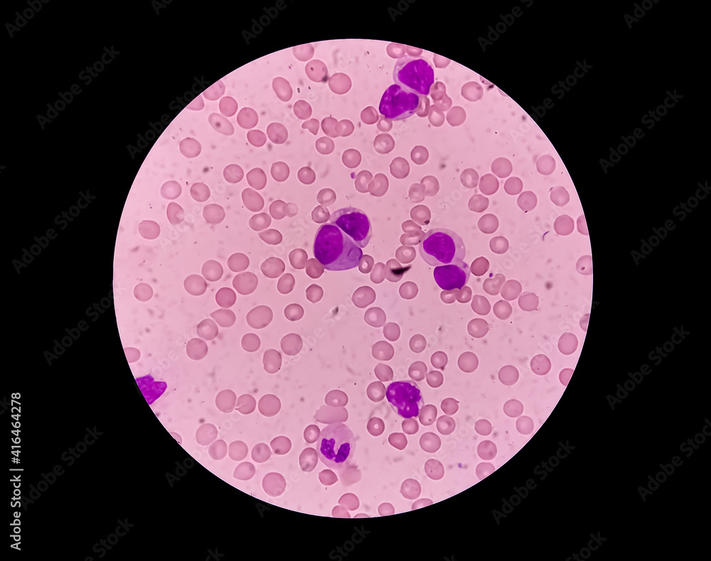 Microscopic view of Acute myeloid leukemia (AML), myeloblastic Leukemia ...