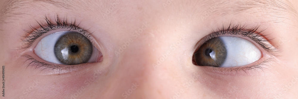 Child's face with squint and freckles on nose. Strabismus in children ...