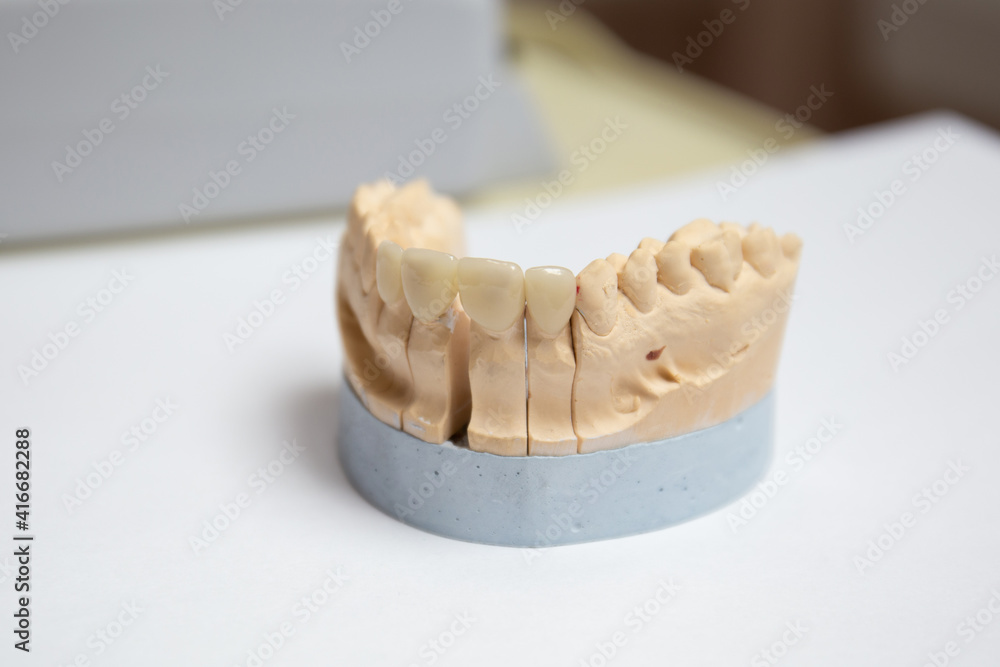 Plaster model of the artificial jaw with veneers.Concept of aesthetic ...