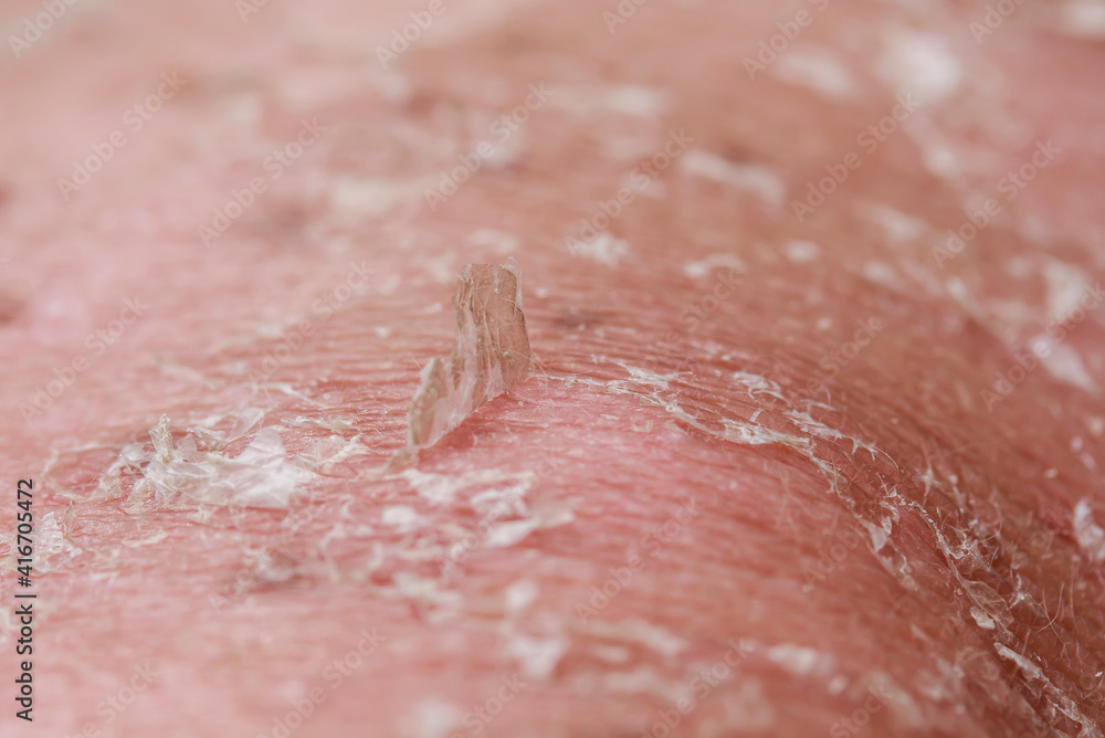 texture of problematic human skin close up with pigmentation and ...