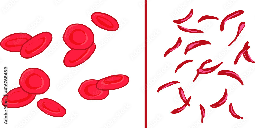 Vector Illustration of Sickle Cell Anemia, Health Stock Vector | Adobe ...