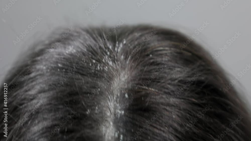 A woman tilts her head forward and shows dirty dark hair with dandruff ...