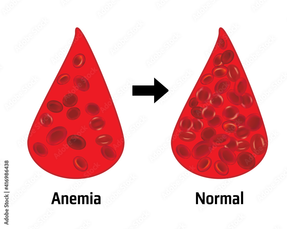 Anemia and normal ammount of red blood cells Stock Vector | Adobe Stock
