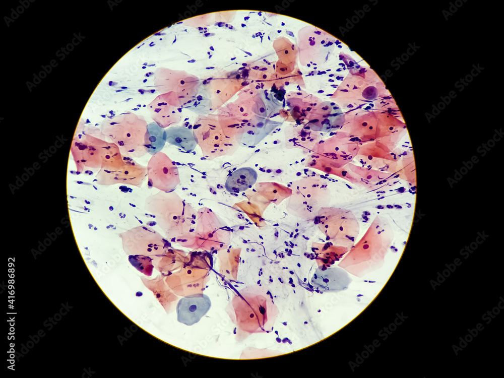 Normal endocervical cells and squamous epithelial cells of cervical ...
