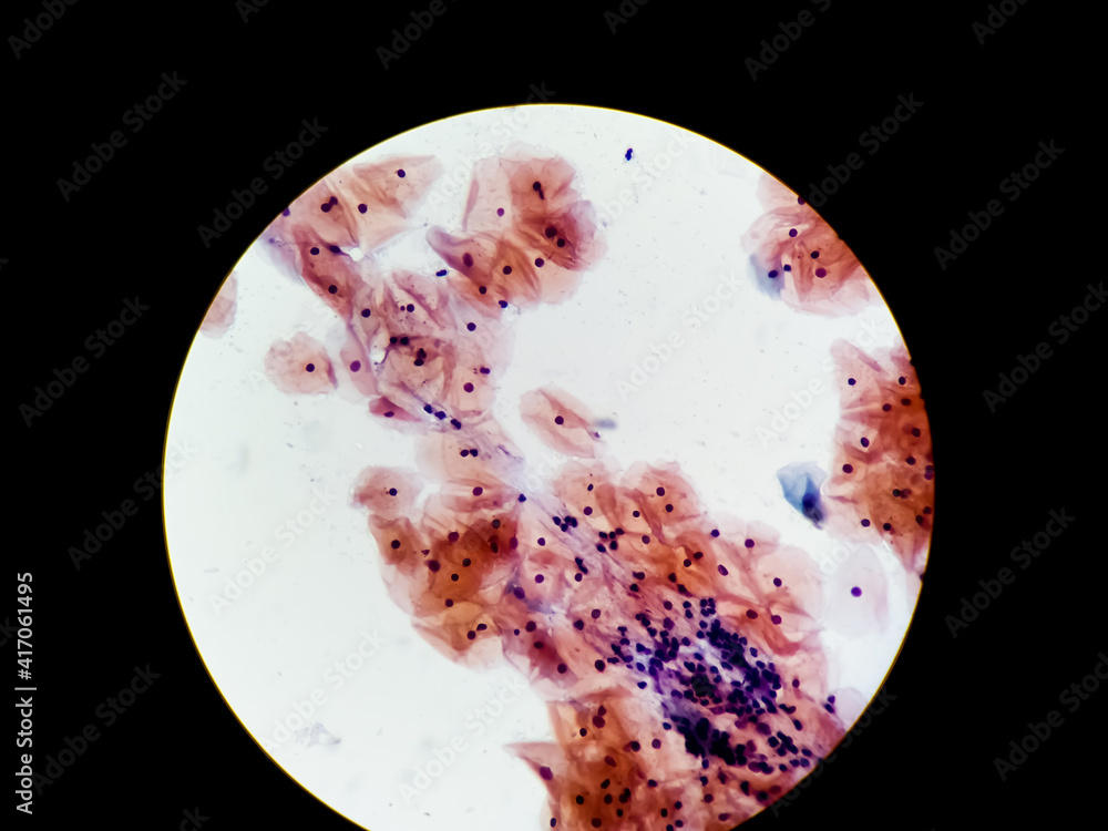 Normal endocervical cells and squamous epithelial cells of cervical ...