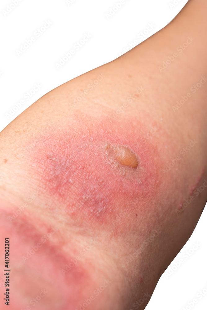 Blister from Rove beetles ,Paederus dermatitis at arm Stock Photo ...
