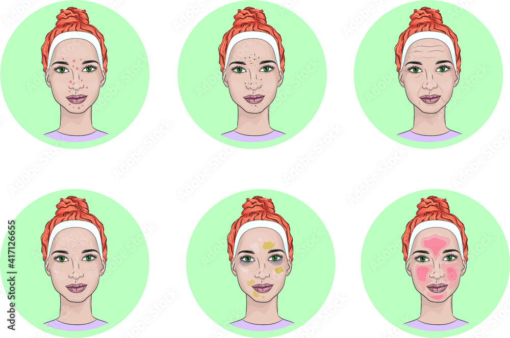 Girl face with skin problems. Common face skin problems Stock Vector ...