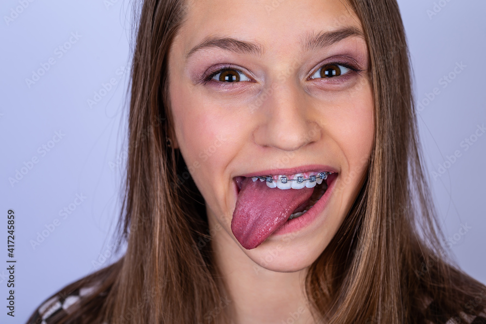 Teenager With Smile Shows White Teeth With Braces White Background