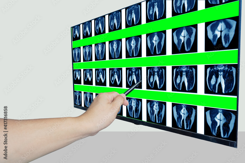 MRI Of Hip Joint Doctor Pointed On Area Of Hip Joint When Pathology mri-of-hip-joint-doctor-pointed-on-area-of-hip-joint-when-pathology