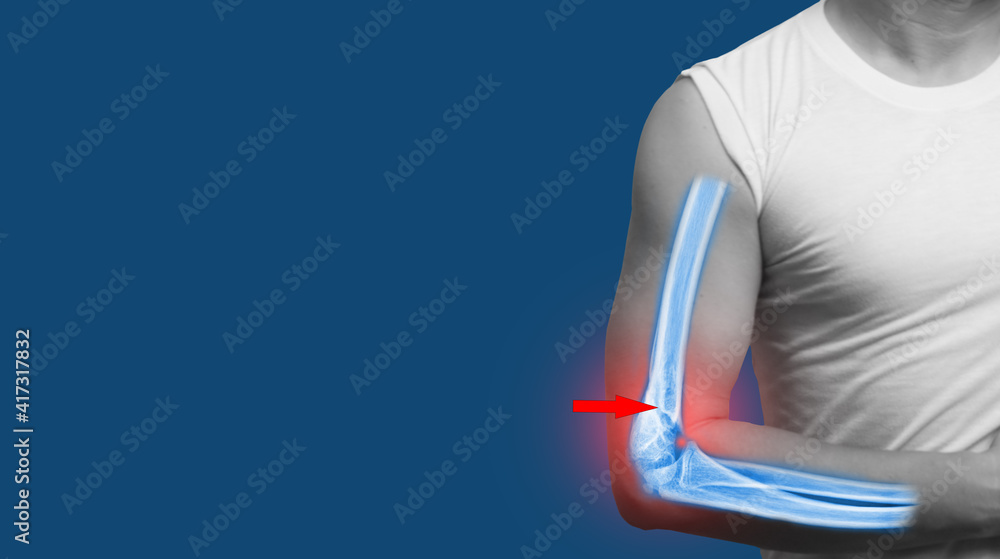 Film X-ray elbow radiograph show elbow bone broken from fall accident ...