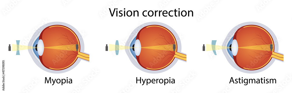 Correction of various eye vision disorders by lens. Hyperopia, myopia ...