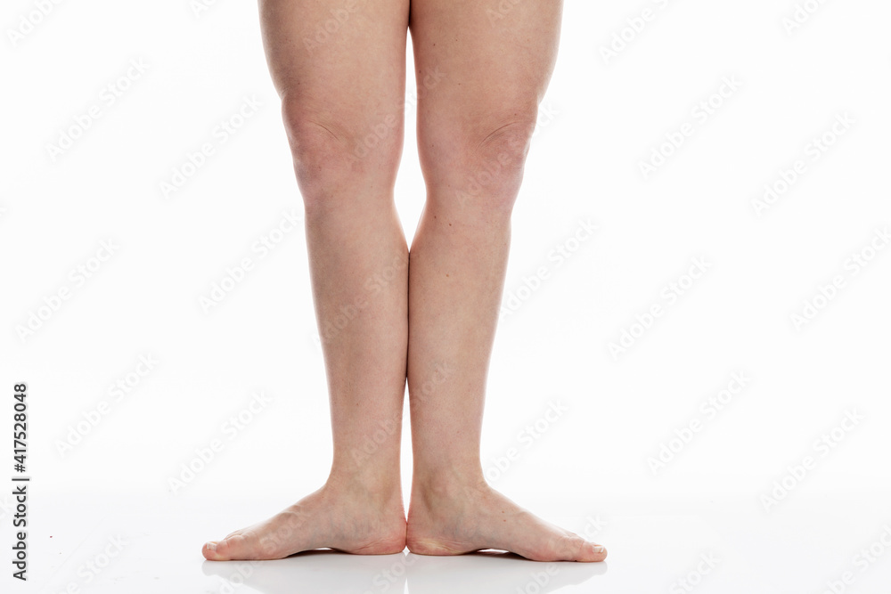 Bare female legs with spider veins. Realistic photo. Stock Photo ...