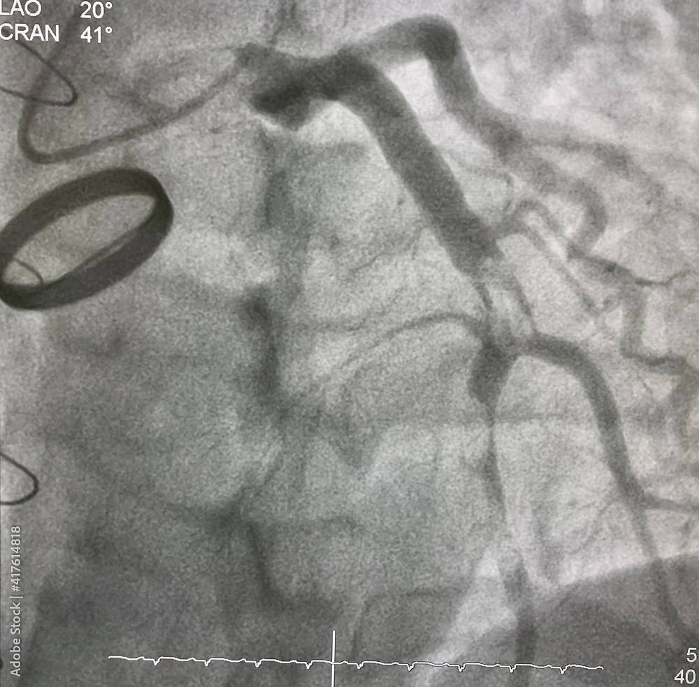 coronary angiogram shown massive thrombus that occluded left anterior ...