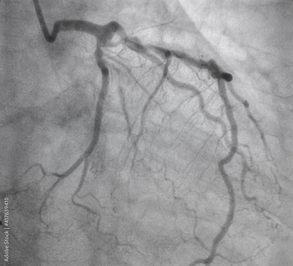 Coronary angiogram , medical x-ray for heart disease. Coronary artery ...