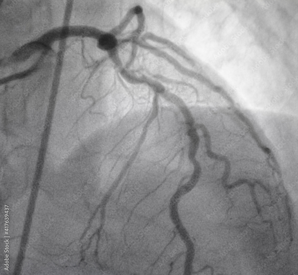 Foto de Coronary angiogram , medical x-ray for heart disease. Coronary ...