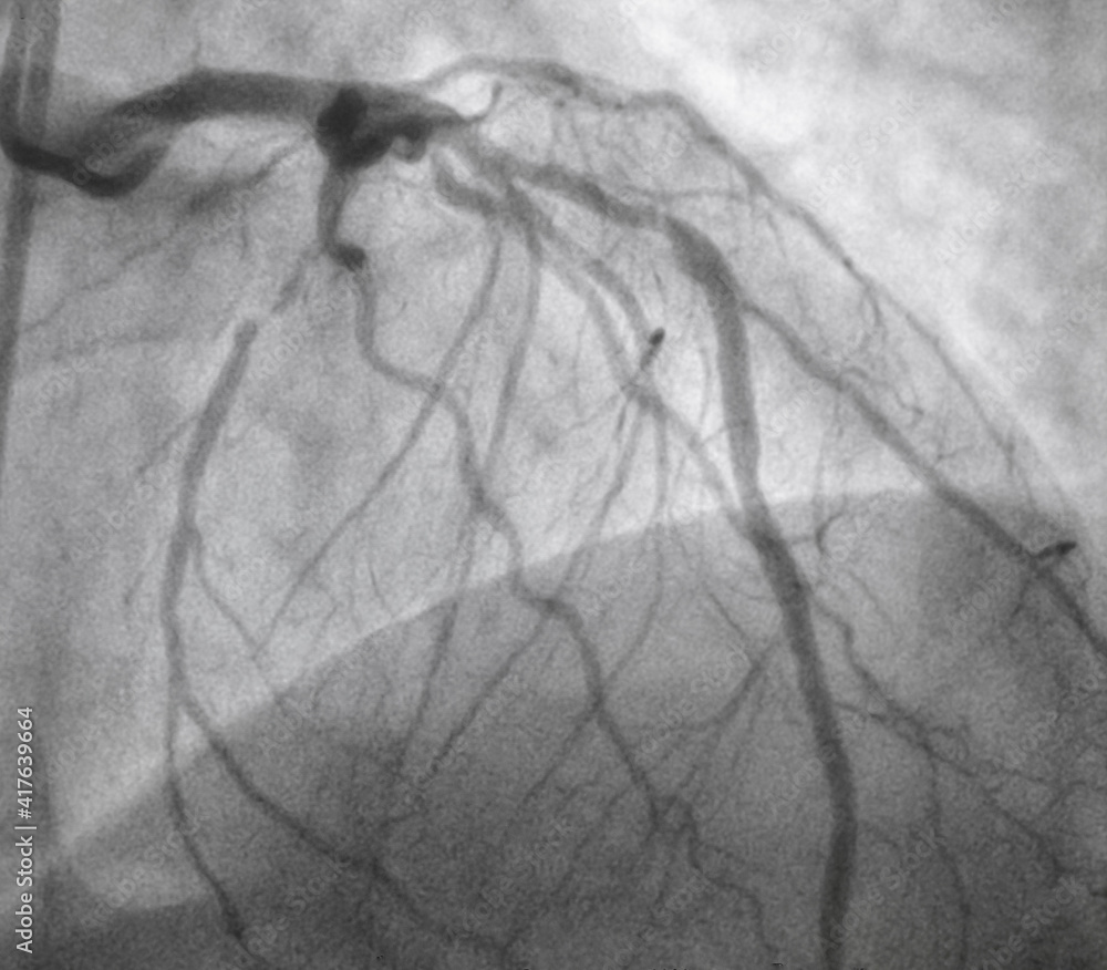 Coronary angiogram , medical x-ray for heart disease. Coronary artery ...