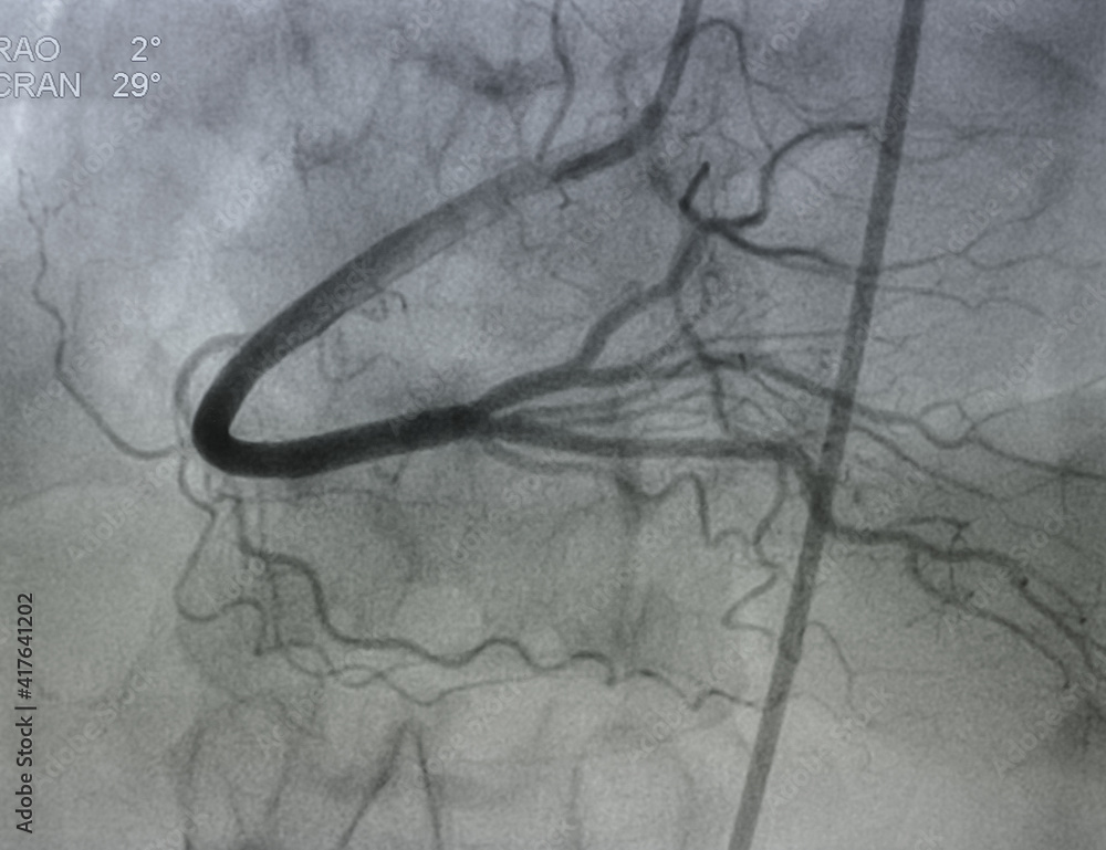 Coronary angiogram , medical x-ray for heart disease. Coronary artery ...