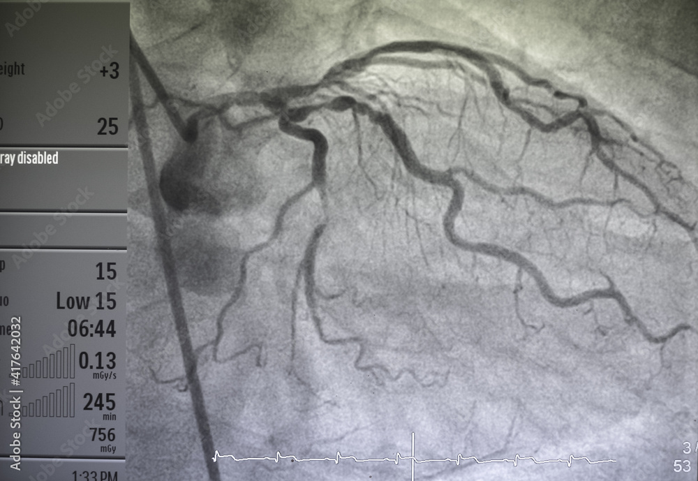 Coronary angiogram , medical x-ray for heart disease. Coronary artery ...