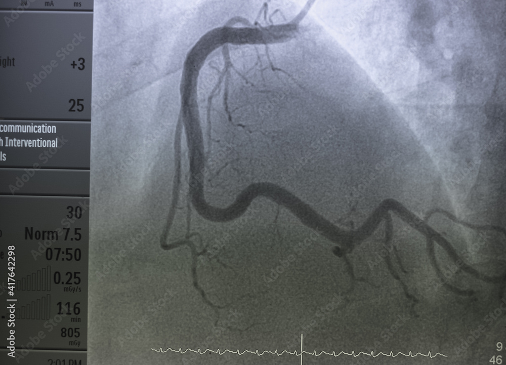 Coronary angiogram , medical x-ray for heart disease. Coronary artery ...