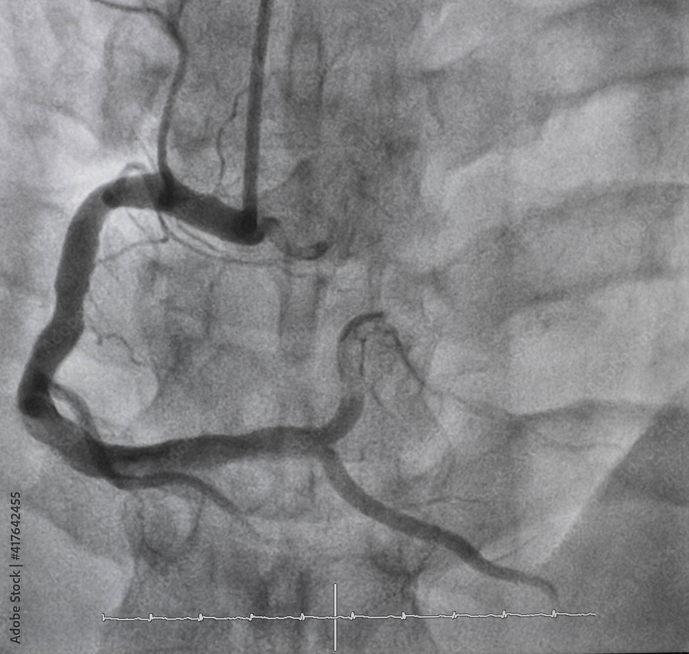 Coronary angiogram , medical x-ray for heart disease. Coronary artery ...