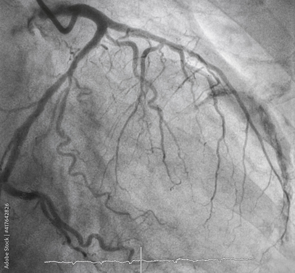 Coronary angiogram , medical x-ray for heart disease. Coronary artery ...